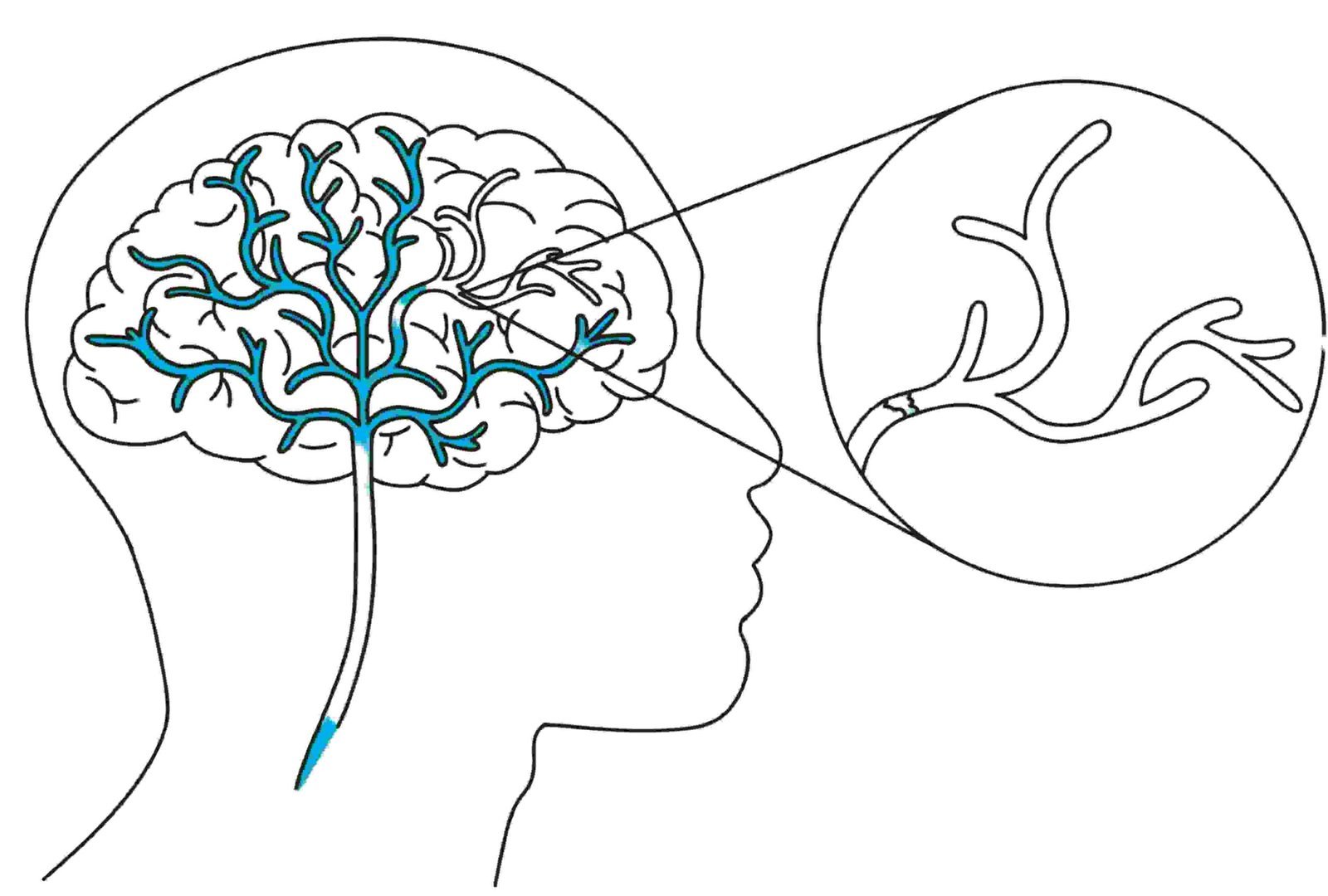 Recognising Stroke Signs: Why Every Second Matters